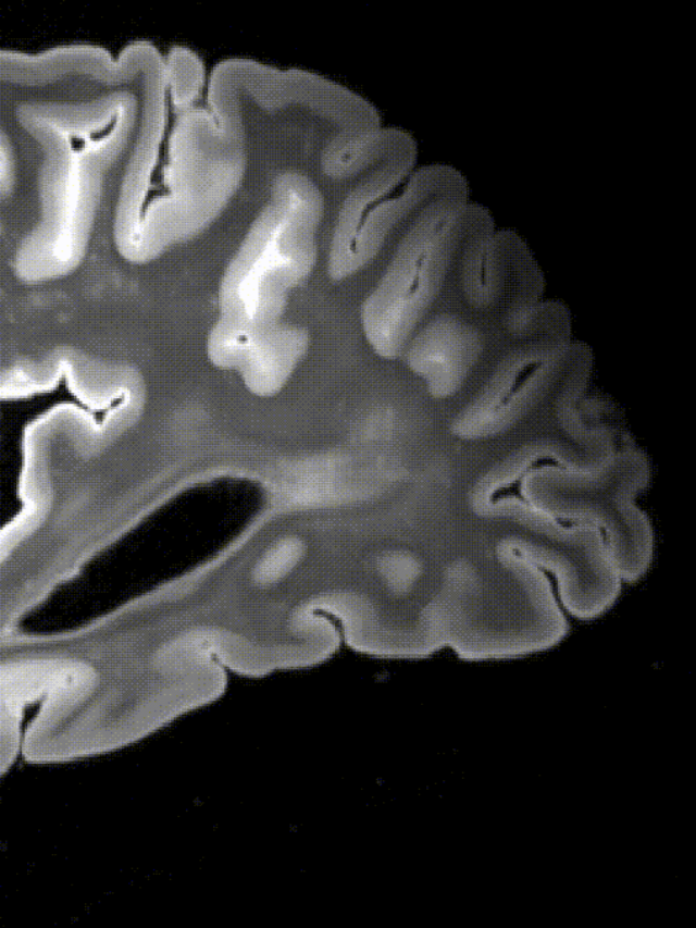 University of Pennsylvania's 7-Tesla High-Res MRI Study: How UPenn's ...