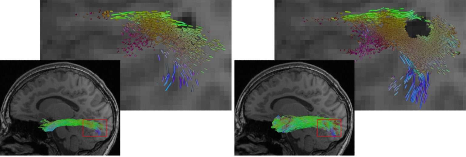 AI-Powered Brain Mapping Enhances Surgery Precision at Bonn University ...
