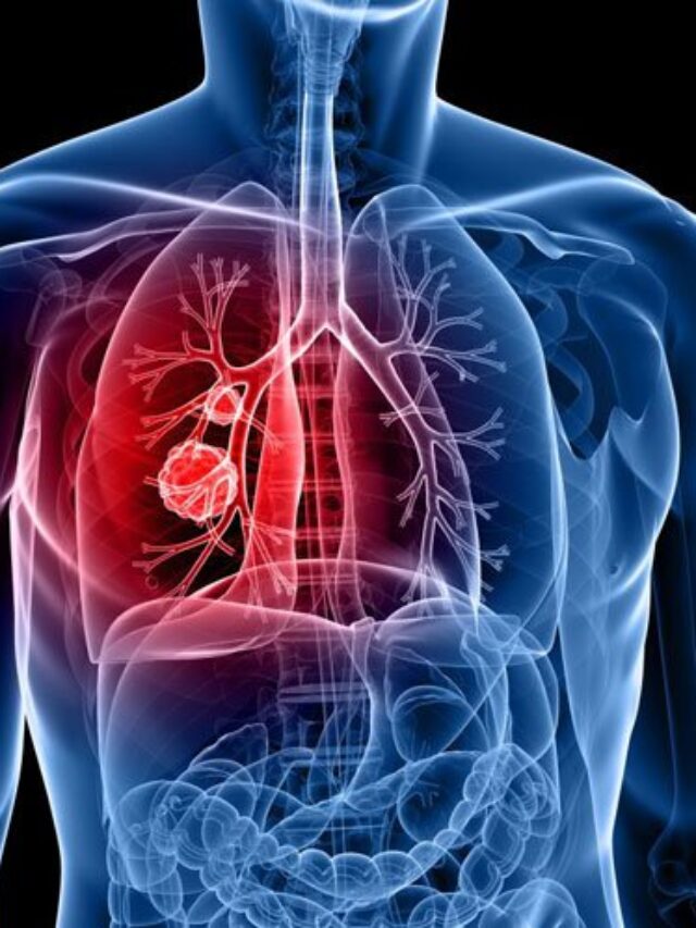 Ariceum's SSTR2-Targeting SCLC Therapy Gets FDA Orphan Status - Karmactive